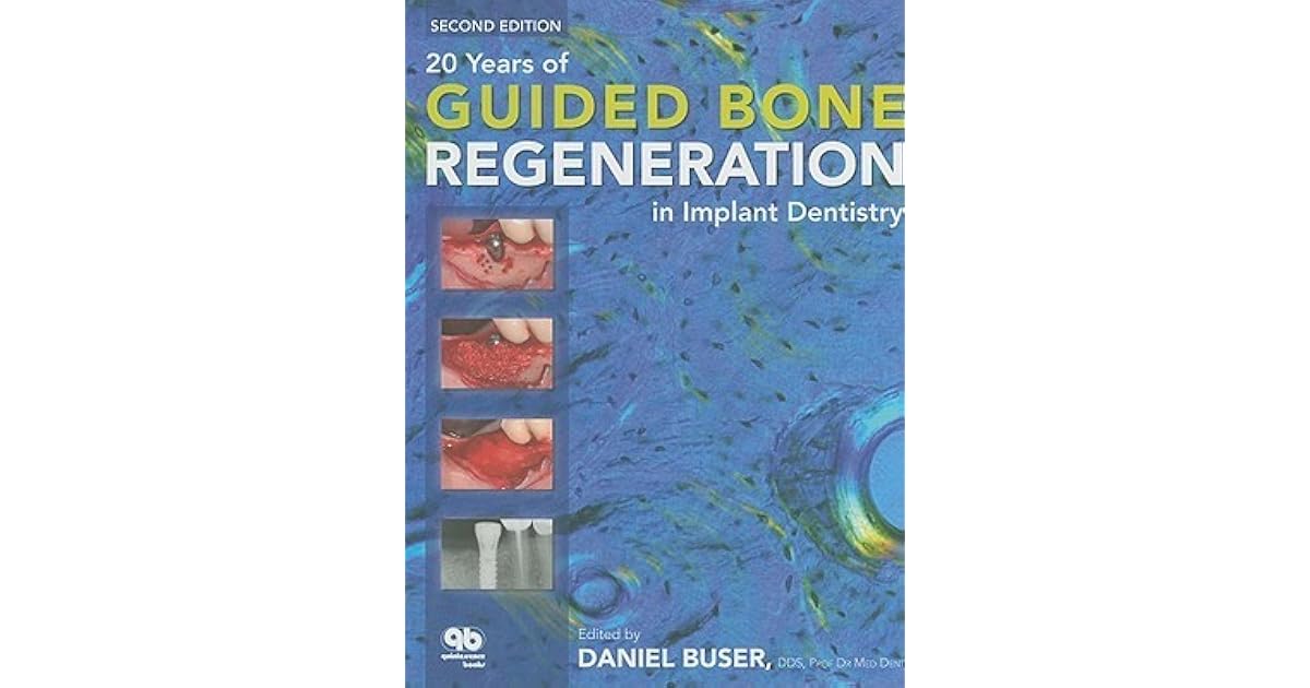 20 Years of Guided Bone Regeneration in Implant Dentistry by Daniel Buser