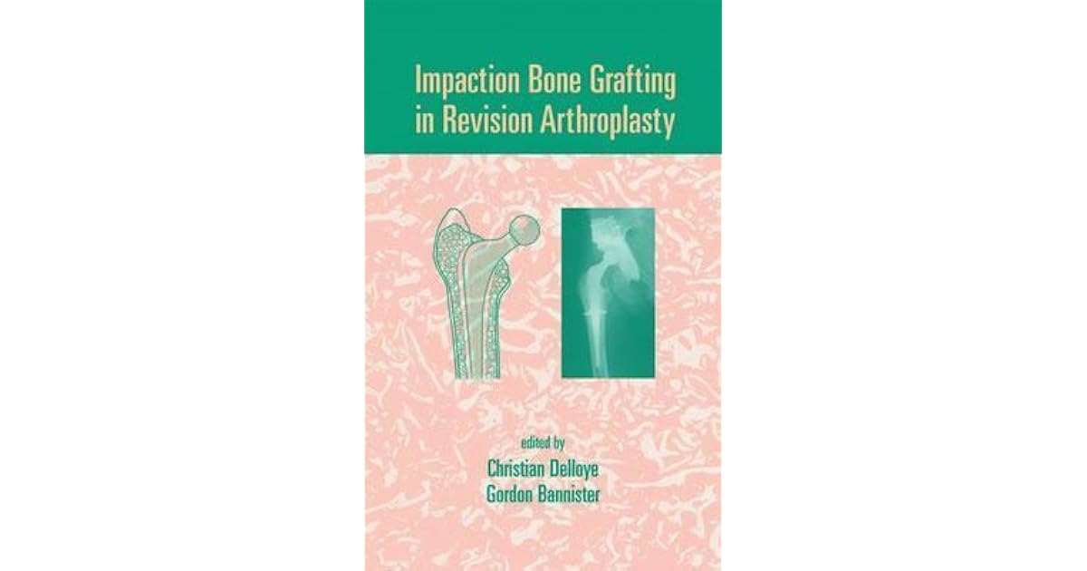 Impaction Bone Grafting in Revision Arthroplasty by Christian Delloye