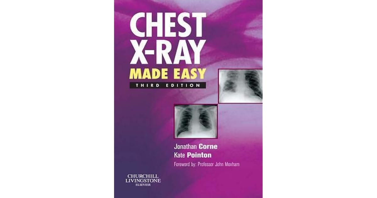 Chest X-Ray Made Easy E-Book by Jonathan Corne