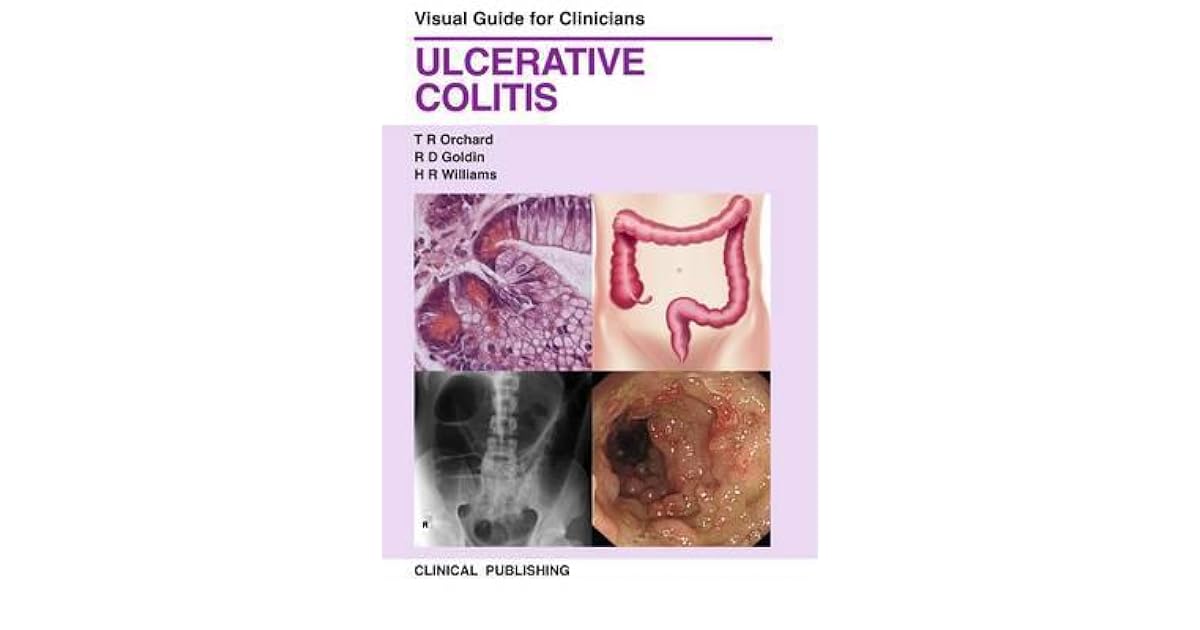 Ulcerative Colitis: Visual Guide for Clinicians by Orchard