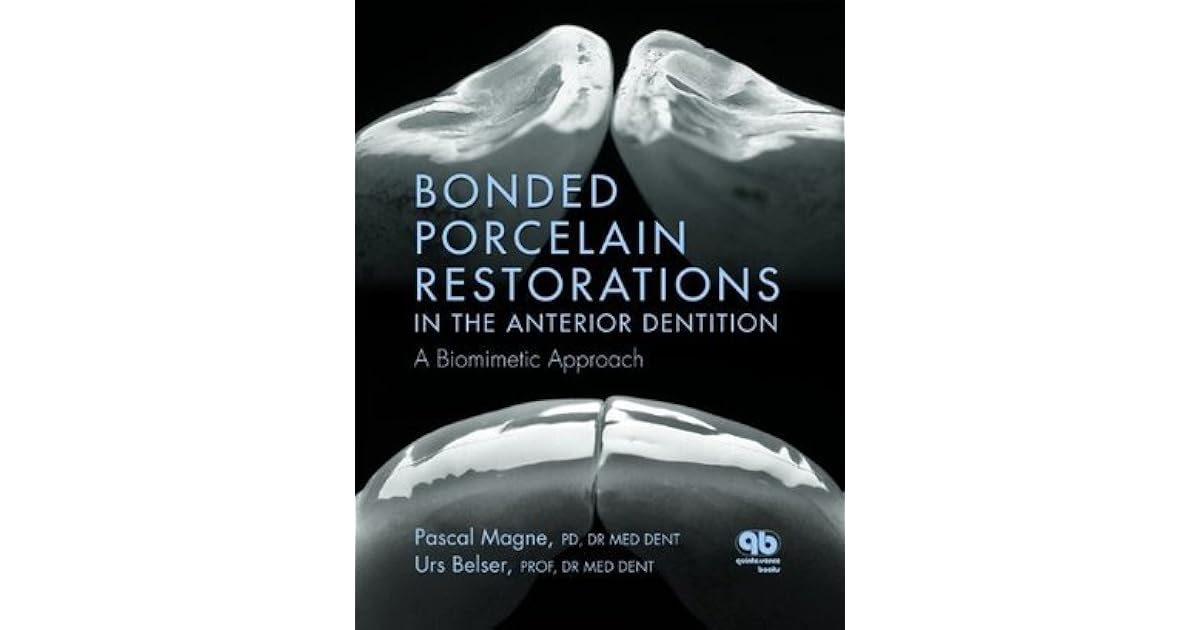 Bonded Porcelain Restorations in the Anterior Dentition: A Biomimetic ...