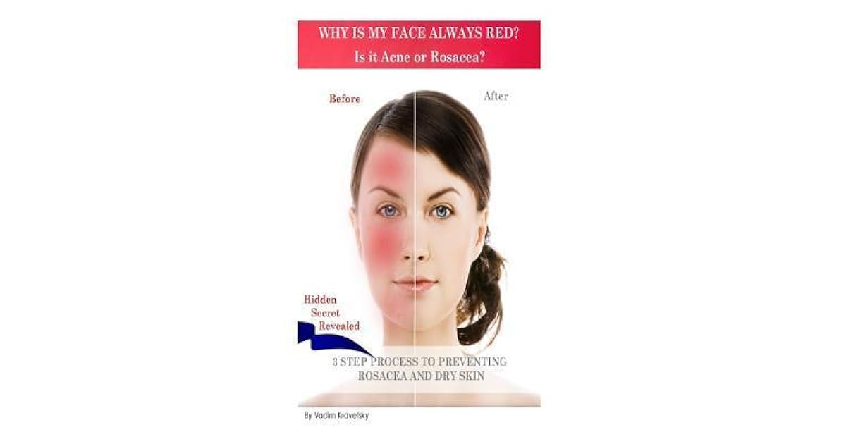 Why is my face always red? Is it Acne or Rosacea?: 3 step process to ...