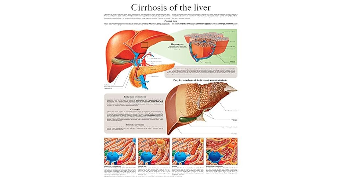 Cirrhosis of the liver e-chart: Full illustrated by HC-HealthComm