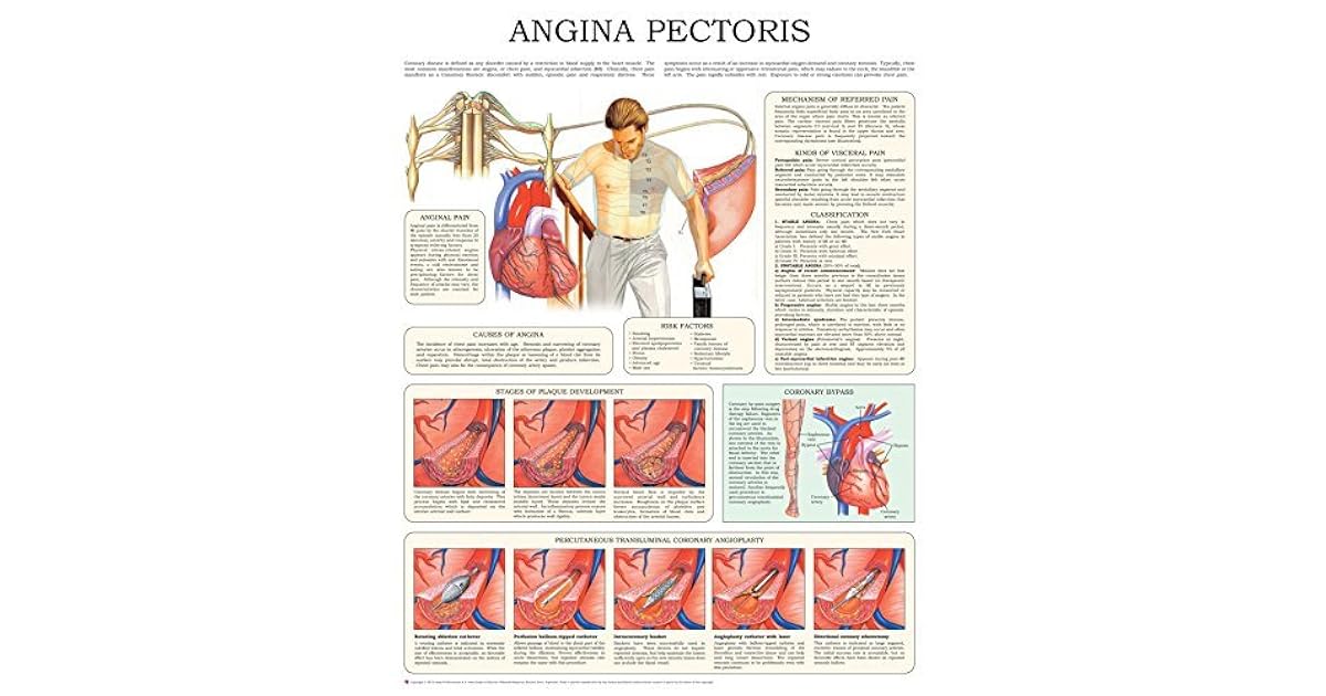 Angina pectoris e-chart: Quick reference guide by HC-HealthComm
