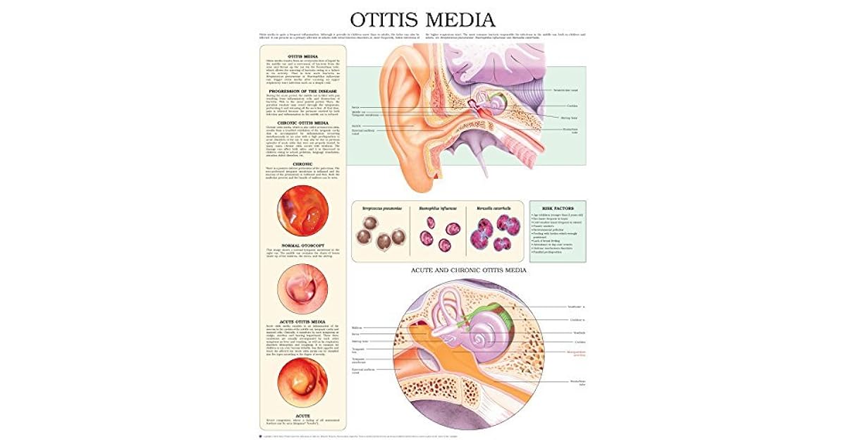 Otitis Media e chart: Full illustrated by HC-HealthComm